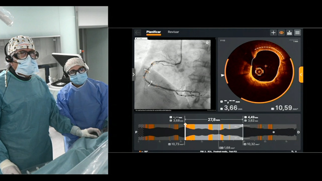 Treat calcium right the first time: new considerations for PCI planning ...