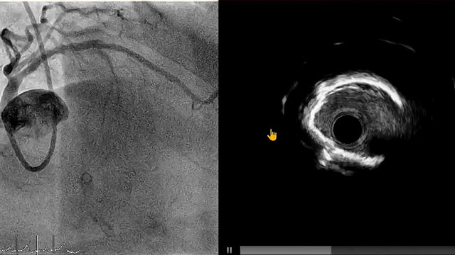 Which device for which patient: DES, BRS or DCB?