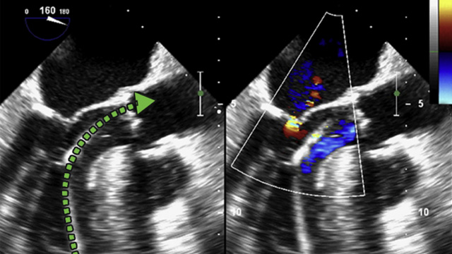 Improving aortic stenosis diagnostic accuracy