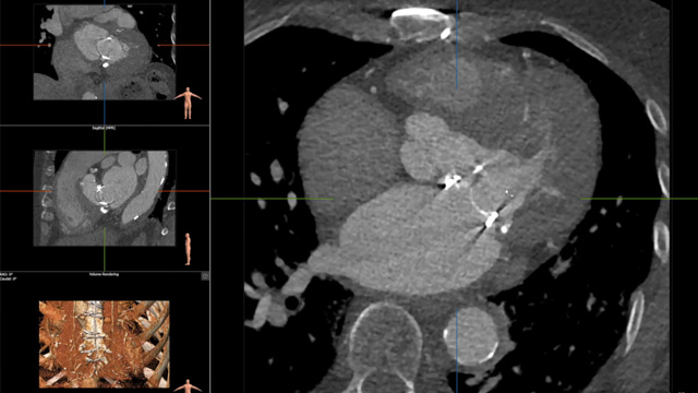 Mitral valve-in-valves: echocardiography and CT scan