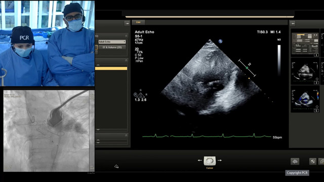 Step-by-step TAVI in bicuspid aortic stenosis - LIVE case