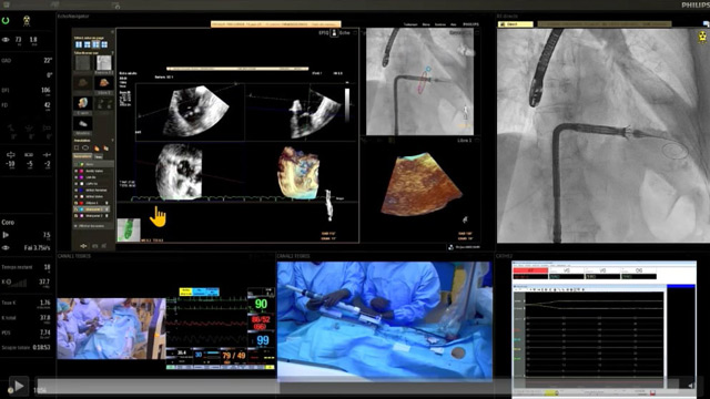 Tricuspid transcatheter therapies: the game changer