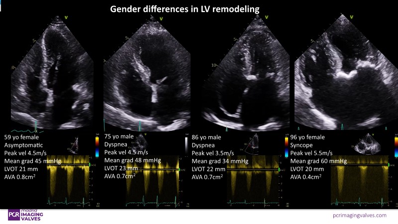 Aortic valve disease - Aortic stenosis management: Diagnosis ...