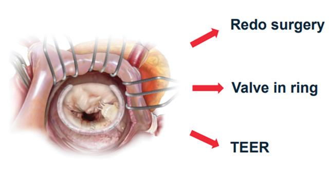 Featured research: latest advances in mitral TEER and valve repair ...