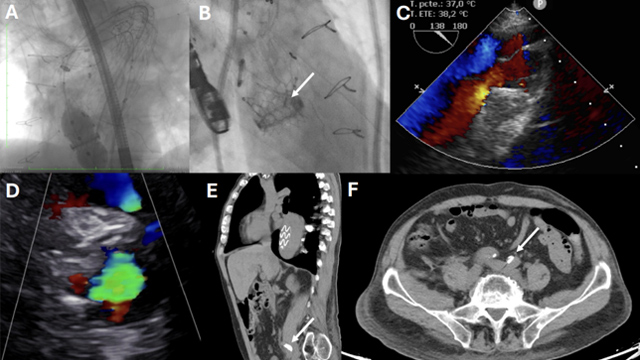 Featured research - TAVI: MELA, ViMech & more
