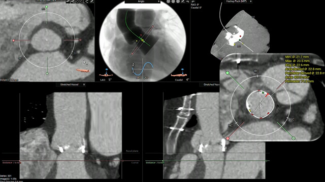 Getting the full potential of the supra-annular valve in a changing ...