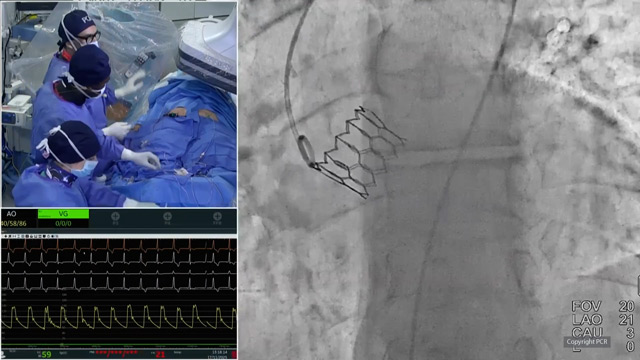 Myval THV series - Optimise patient outcomes with novel design, data ...