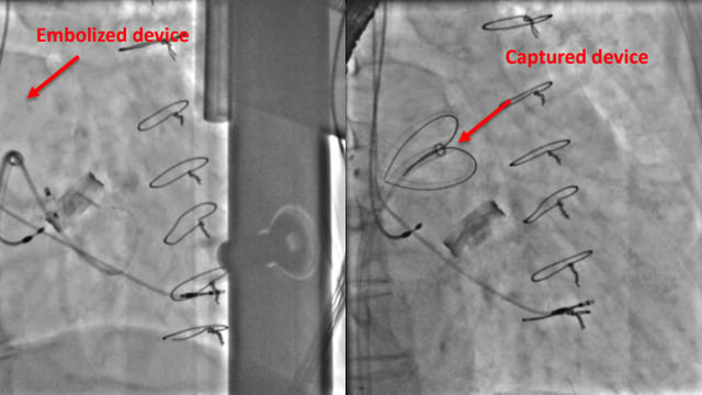 Retrieval of embolised devices