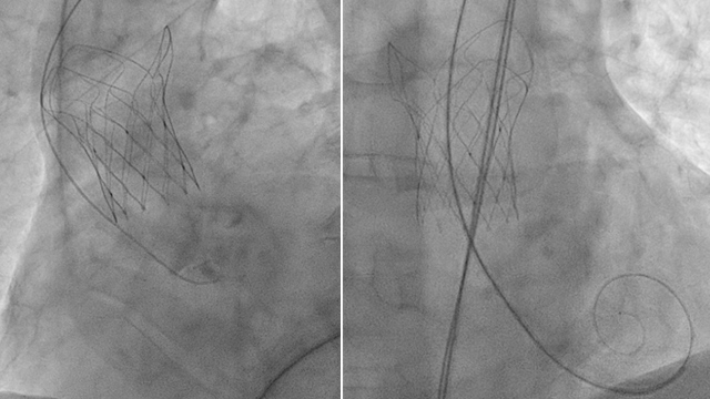 TAVI complications