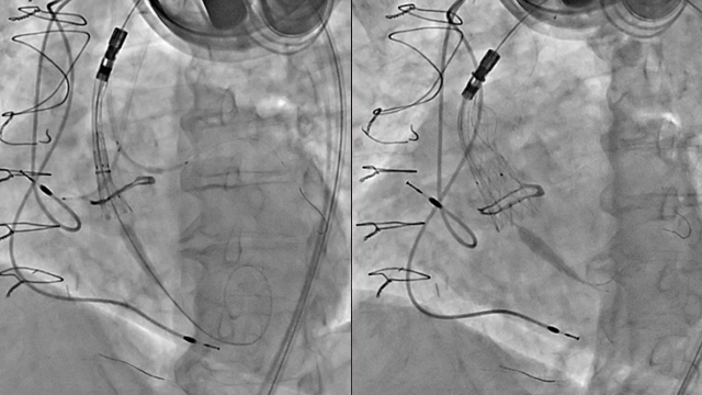 TAVI: high coronary risk - Part 2