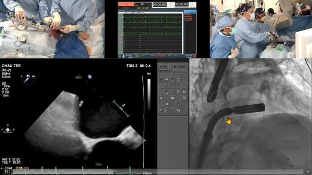 Orthotopic mitral devices coming soon