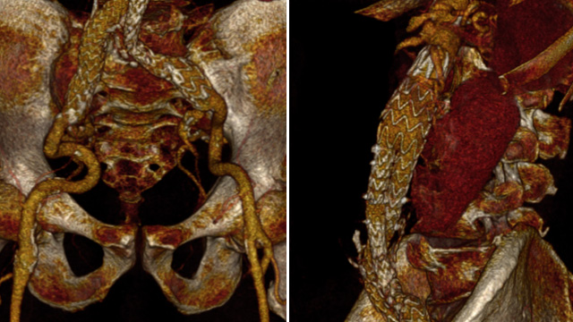 Out-of-the-box TAVI: when anatomy pushes innovation