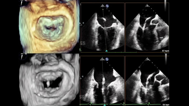 The role of mitral TEER in advanced heart failure