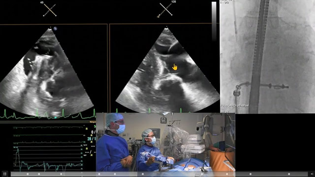 Basic imaging and procedural steps for T-TEER