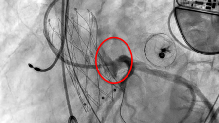 TAVI (Transcatheter aortic valve implantation)