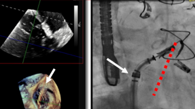 Indication and device selection for tricuspid interventions