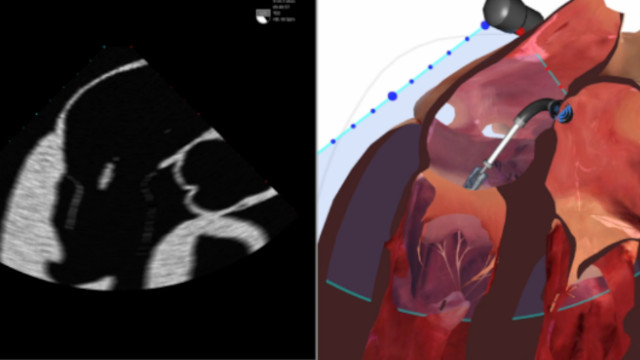 M-TEER for challenging anatomy