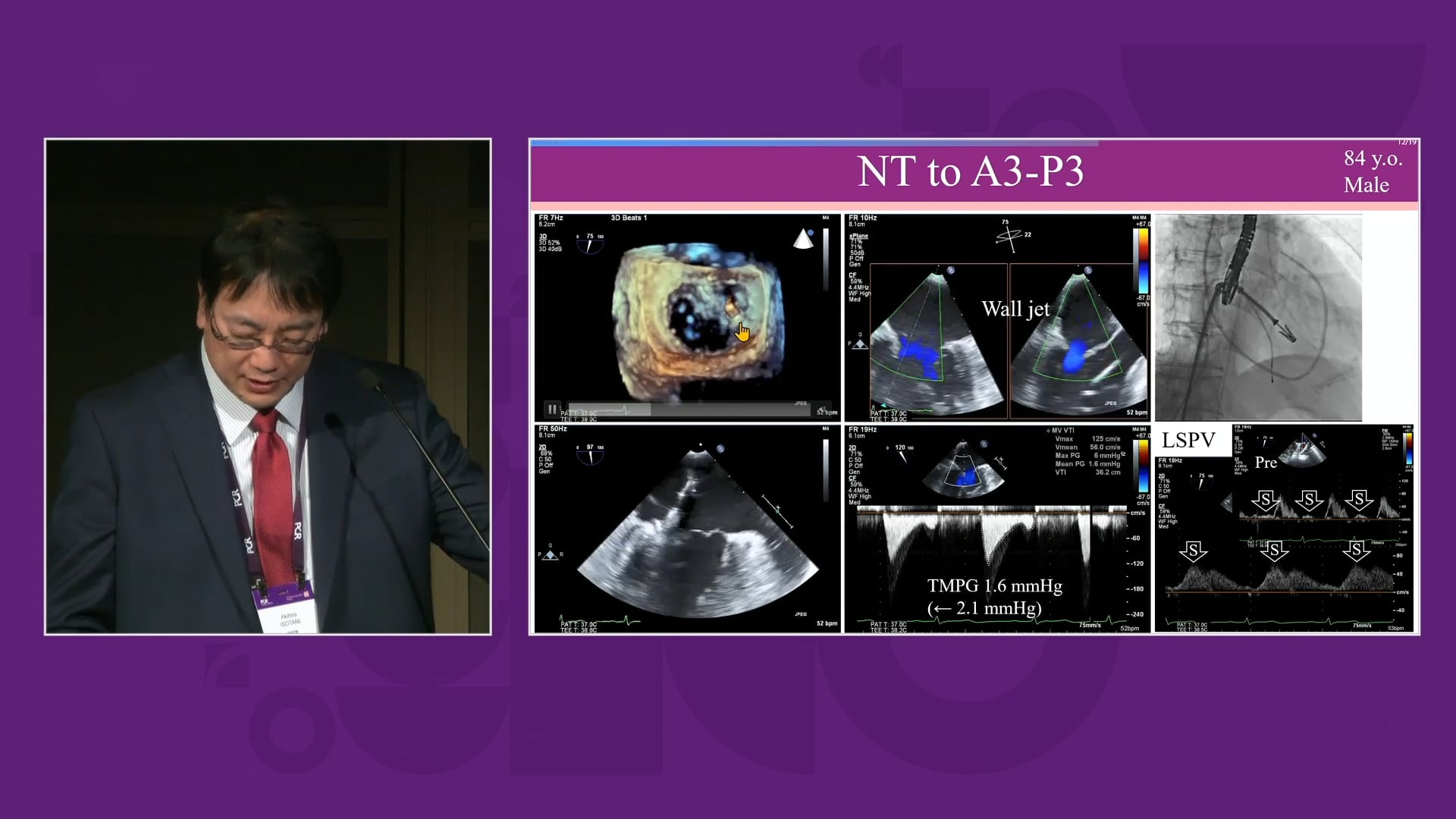 M-TEER for primary mitral regurgitation