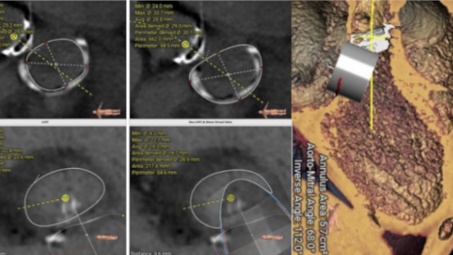 Mitral valve-in-valve and valve-in-ring electrosurgery