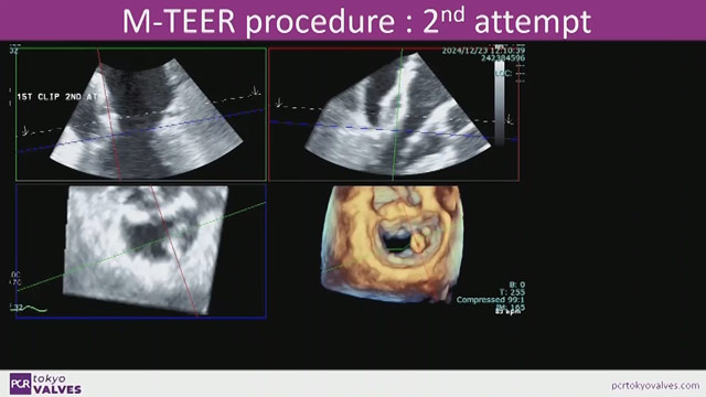 More possibilities in TEER - Treatment of degenerative mitral regurgitation
