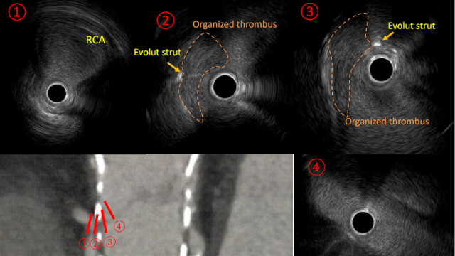 TAVI and coronary artery disease