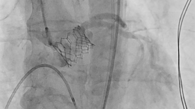 TAVI complex cases: intravascular hemolysis, Heyde syndrome & more