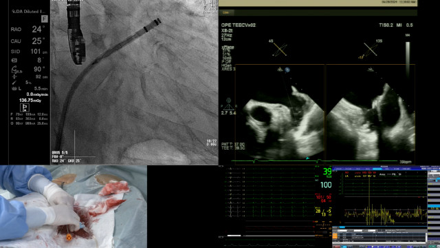 The value of WATCHMAN therapy - Who should we treat?