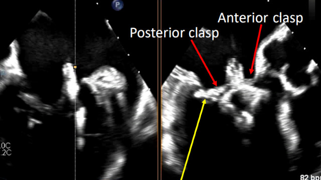 Tips and tricks for M-TEER