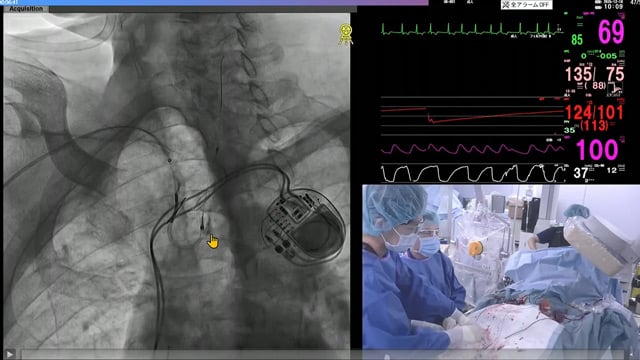 New horizons in structural heart disease therapy - Cutting-edge stroke ...