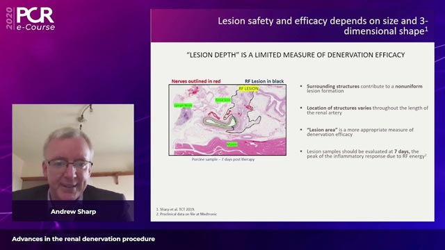 Advances in the renal denervation procedure