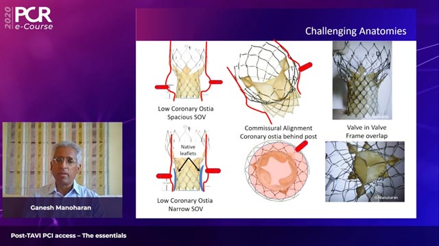 Tips and tricks to achieve PCI access after transcatheter aortic valve ...