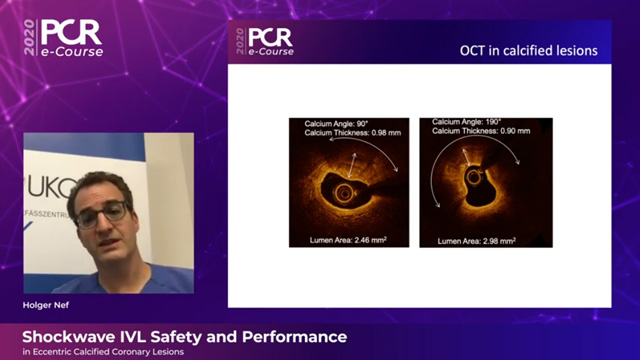 Shockwave IVL Safety and Performance in Eccentric Calcified Coronary ...