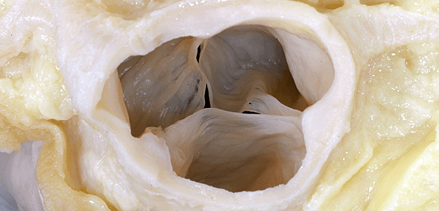 aortic leaflet