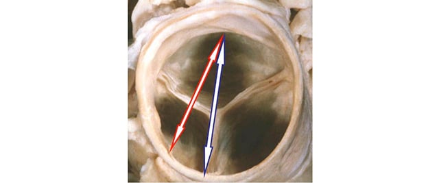 Aortic root diameters