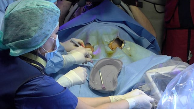 ECLS: technique of implantation and/or explantation of the cannula