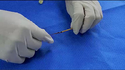 How to reduce the profile of an already inflated angioplasty balloon?