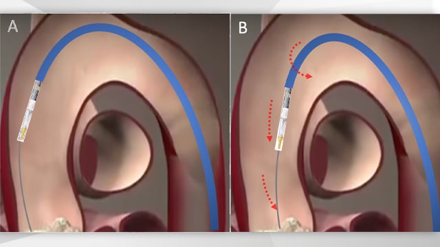 Inner curvature technique for the implantation of a balloon-expandable ...