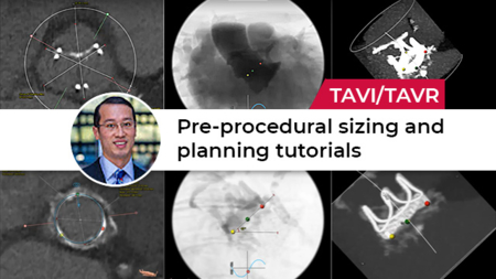 TAVI (Transcatheter aortic valve implantation)