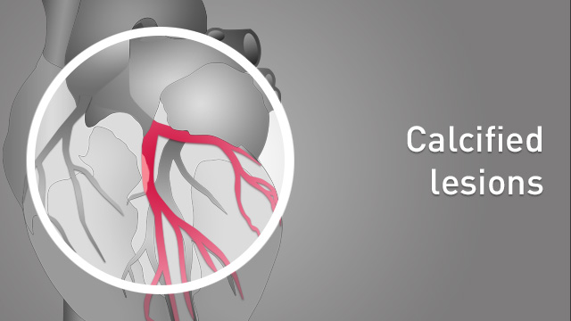 Zoom on radial access, calcified lesions, interventional cardiovascular ...