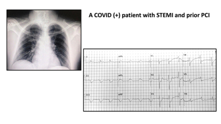 NSTEMI (Non-ST-segment elevation myocardial infarction)