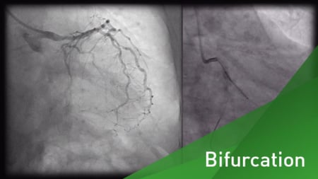 Bifurcation lesions