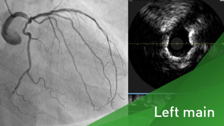 Left main and multivessel disease