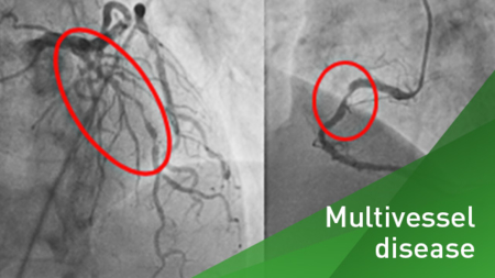 Stents and scaffolds
