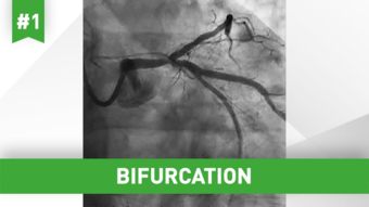 Bifurcation lesions