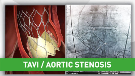 TAVI (Transcatheter aortic valve implantation)