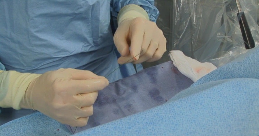 Punction with metallic needle