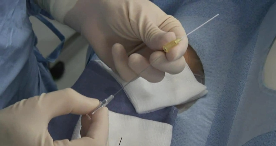 Punction with plastic needle