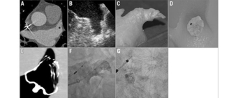LAA (Left Atrial Appendage) closure
