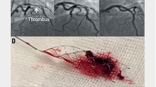 The Solitaire device – on the cards for retrieval of recalcitrant ...