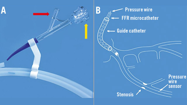 Continuous intracoronary versus standard intravenous infusion of ...